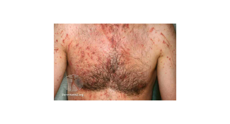 Summer rashes: How to protect against & treat common skin irritations ...